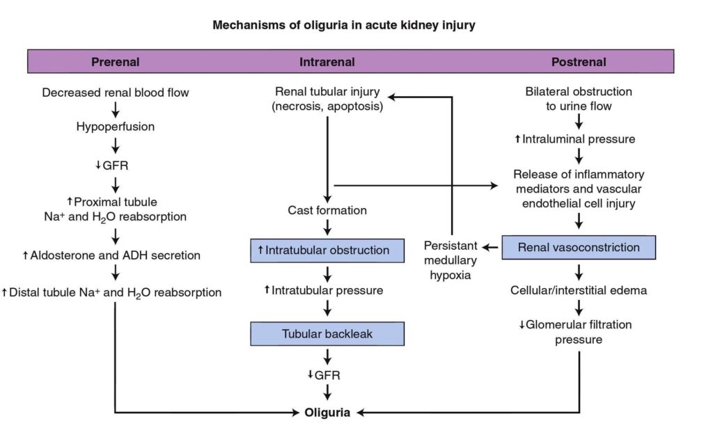 oliguria acute kidney injury explained