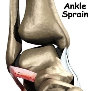 Ankle Sprain Intro Image