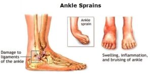 Ankle Sprains Diagram Image - Graph Diagram