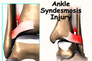 Ankle Syndesmosis Diagram Image