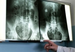 Kidneys X ray 1