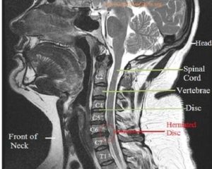Cervical Disk Mri Image