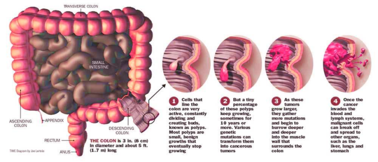 Diagram Colon Cancer Stages Image