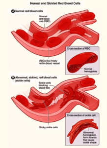 Sickle Cell Image