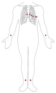 ECG Placement of Electrodes
